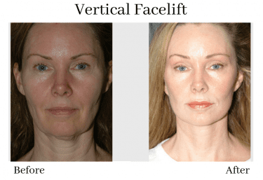 How the Vertical Facelift is Revolutionizing Facial Rejuvenation | Beverly Hills Facelift Institute