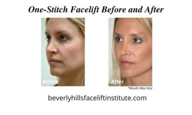Your Complete Recovery Guide to a One-Stitch Facelift | Beverly Hills ...